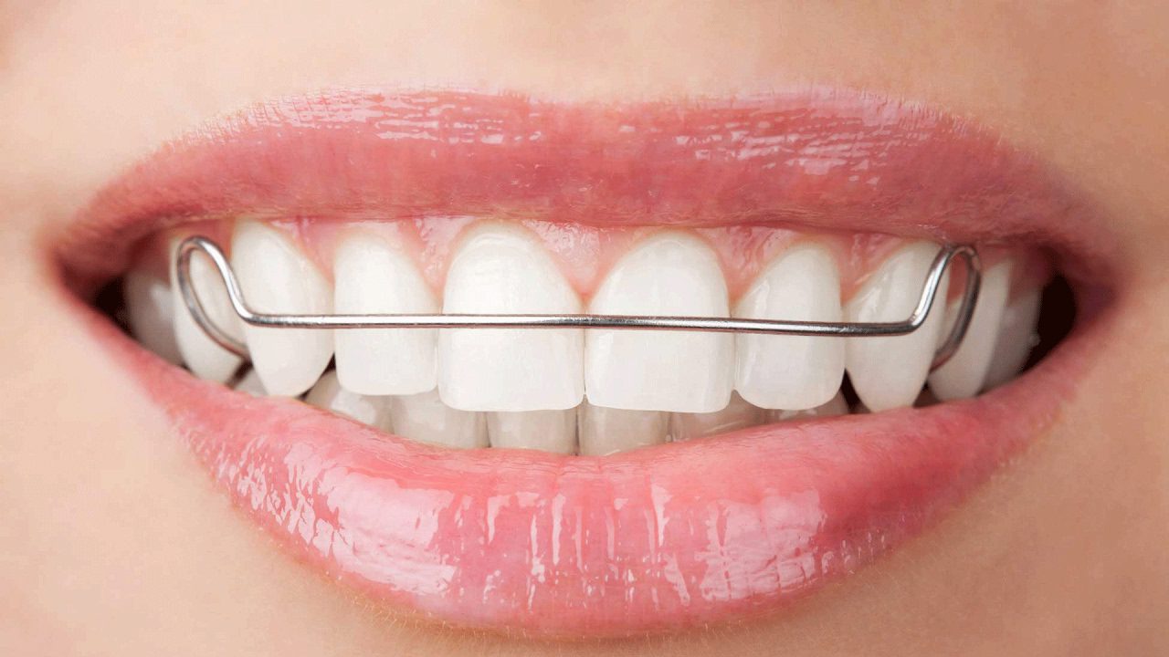 Orthodontic Retention: 3 Ways to Maintain A Straight Smile